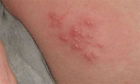 Симптомы и лечение