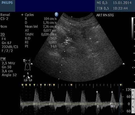 Resistivity Index In RAS Renal Artery Ultrasound Dr Corina Download Scientific Diagram