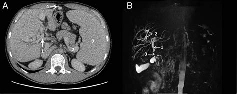 Liver Imaging A Contrast Enhanced Computed Tomography October 2012 Download Scientific