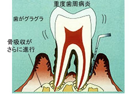 グラグラした歯は治るのか？ インプラントや歯周病治療は横浜・鎌倉・藤沢近くの大船駅北口歯科