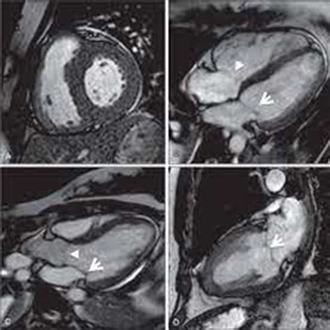 What Is The Procedure Of A Cardiac Mri
