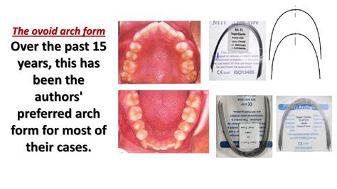 Orthodontic Arch Form Pptx