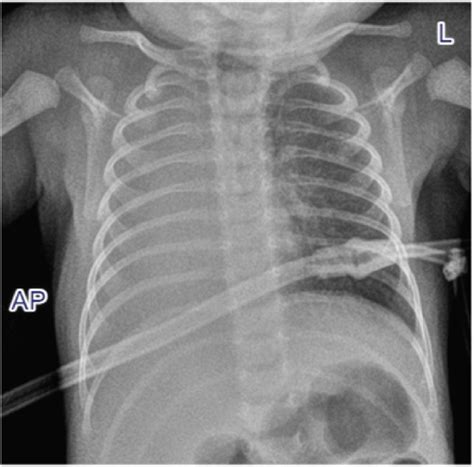 Chest Radiograph Shows A White Out Right Hemithorax With Download