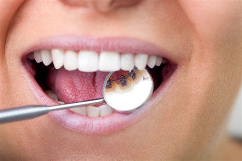 Everything You Need To Know About Lingual Braces