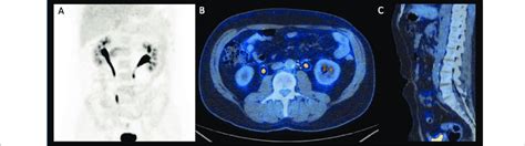 A MIP B Transaxial And C Sagittal 18 F FDG PET CT Fused Image