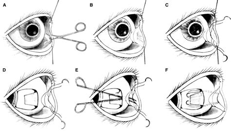 Precaruncular Approach For Medial Orbital Wall Periosteal Anchoring Of
