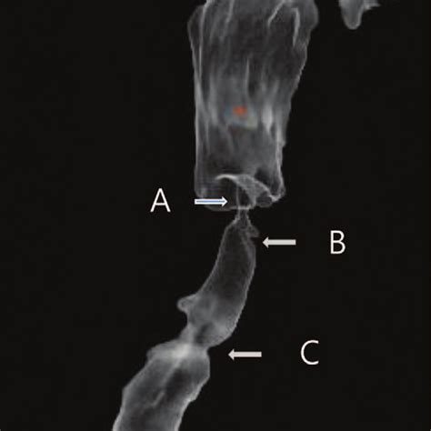 Flow Volume Loops In Pulmonary Function Testing Showing Progressive Download Scientific Diagram