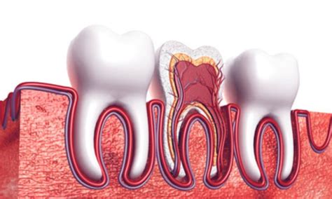 What Are The Signs Of Infection After A Root Canal Wicker Park