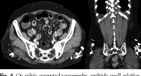 Figure 4 From Subcutaneous Tissue Calcification In A Patient With