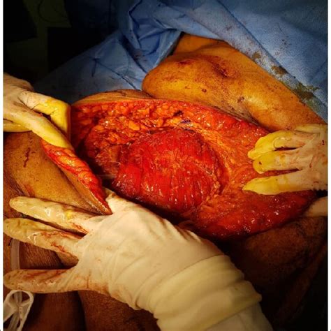 Resection Of Abdominal Wall Sarcoma Of The Iliac Bone Download Scientific Diagram