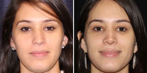 Types Of Nose Surgery Rhinoplasty To Breathe Better Clinique Dallas