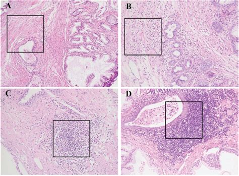 Varying Degrees Of Histological Prostatitis Hande 200 Download Scientific Diagram