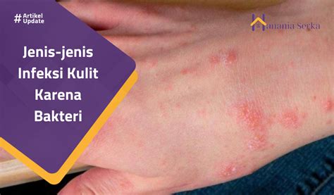 Jenis Jenis Infeksi Kulit Karena Bakteri Hanania Serka