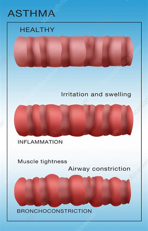 Bronchoconstriction Asthma Illustration Stock Image C027 6704