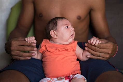 Whats Behind Brazils Alarming Surge In Babies Born With Small Heads