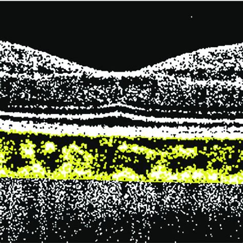Post Acquisition Spectral Domain Optical Coherence Tomography Image