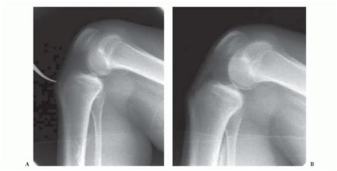 Surgical Treatment For Symptomatic Osgood Schlatter Disease