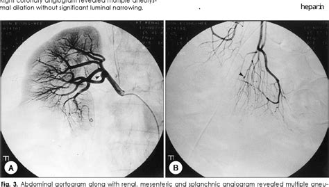 Figure 1 From Polyarteritis Nodosa Presenting As Acute Myocardial