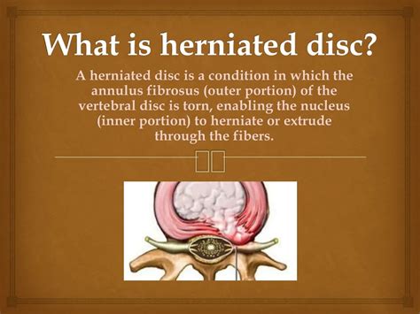 Ppt What Is Herniated Disc Powerpoint Presentation Free Download