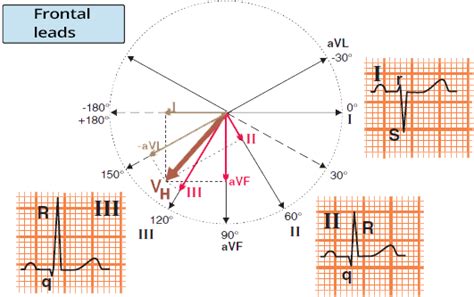 Left Posterior Fascicular Block Lpfb Ecg