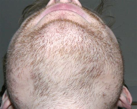 Any Hope For My Beard Patches Beard Board