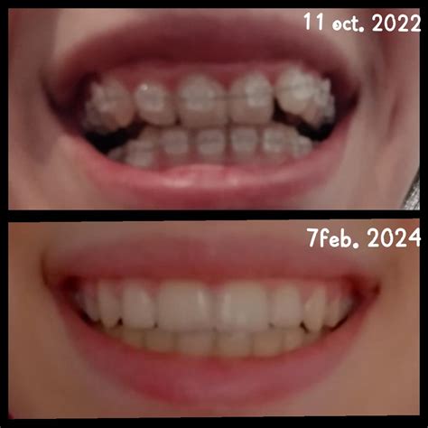 Retainers After Braces Rbraces