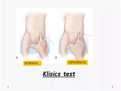 Developmental Dysplasia Of Hip Pptx
