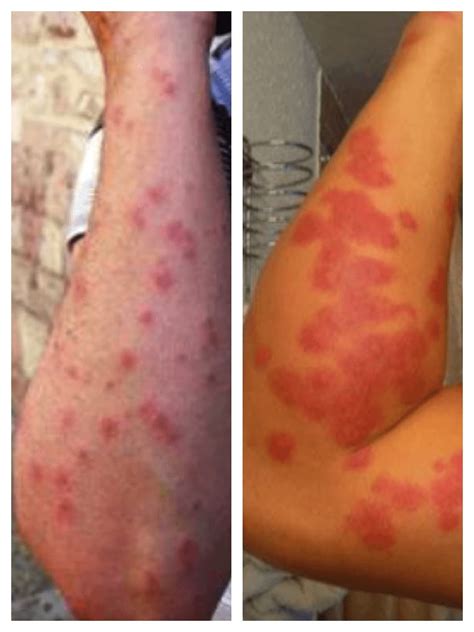 Bed Bug Bites On Arm