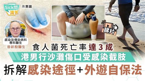 Sick問識答丨港男行沙灘傷口染「食人菌」致截肢 醫生拆解常見感染途徑 外遊自保法 晴報 健康 生活健康 D240626