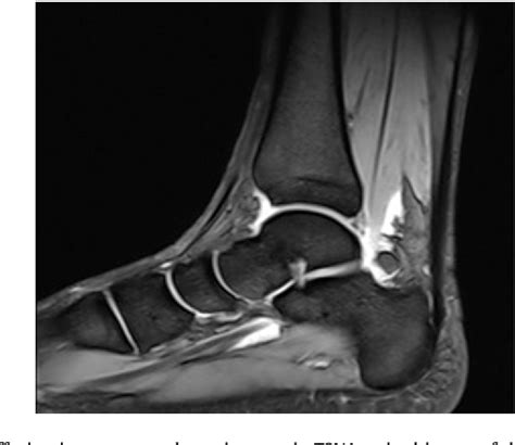 Figure 1 From Posterior Ankle Impingement Syndrome In Football Players