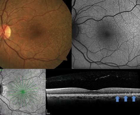 Areds Report Updates Simplified Severity Scale