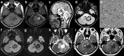 T1w Axial Image A T2w Axial B And Sagittal C Images Show
