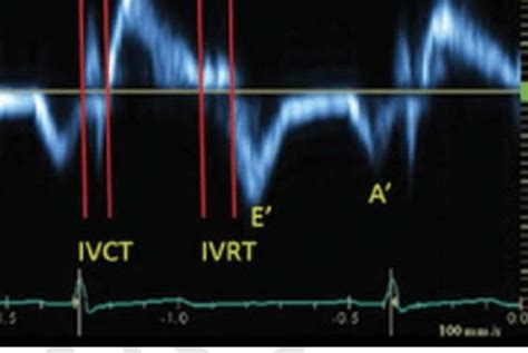 Illustration Of How To Calculate Mpi In Echocardiographic Evaluation
