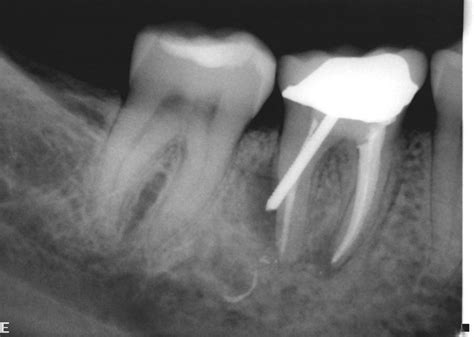 Aventura Endodontic Group Llc Case Reports In Aventura