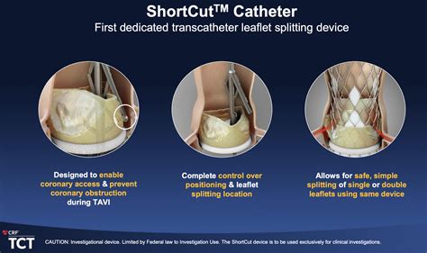 The Shortcut Pivotal Trial A Dedicated Valve Leaflet Splitting Device Cld