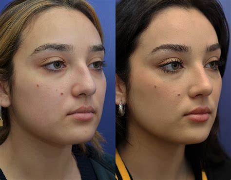 Patient 147739680 Rhinoplasty Gallery Tansavatdi Facial Plastic Surgery