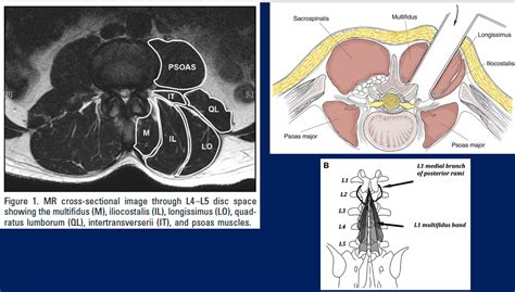 What Is Prone Transpsoas Lateral Interbody Fusion Ptp Lif