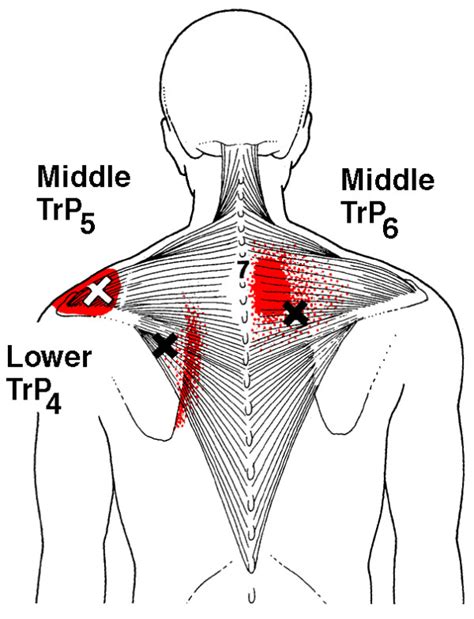 Trigger Point Therapy Release Massage Santa Barbara Goleta Ca