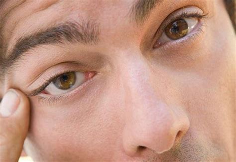 Benign Essential Blepharospasm Causes Symptoms Diagnosis Treatment