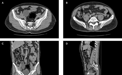 Mucocele Apendicular A Propósito De Un Caso Revista Médica Clínica Las Condes