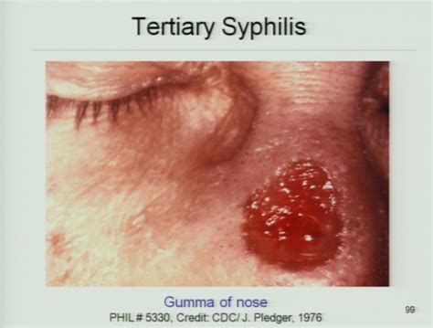 Treponema Pallidum Syphilis Flashcards Quizlet