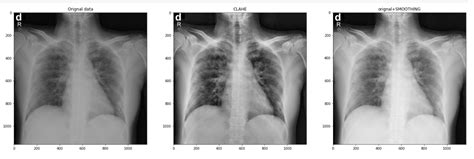 Github Codewithzeal Covid Detection Using Xrays