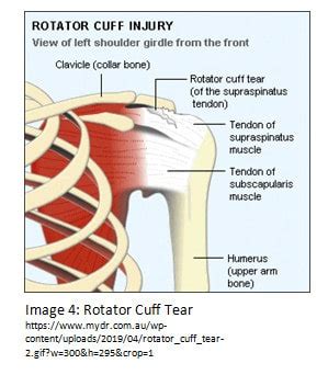 Shoulder Injuries Rotator Cuff Robert Fronjian