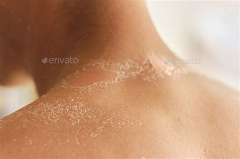 Unrecognizable Guy Got Sunburn And Got Tan Lines On His Back Stock