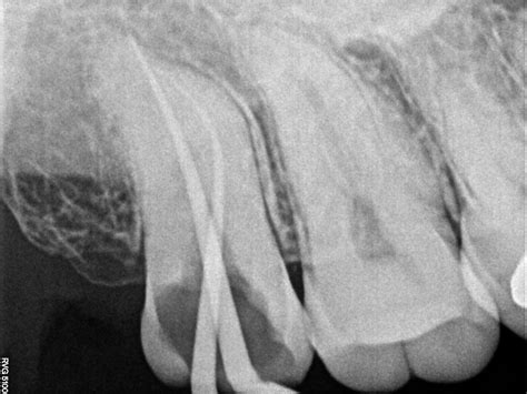 Endodontics Upper Third Molar Root Canal Treatment