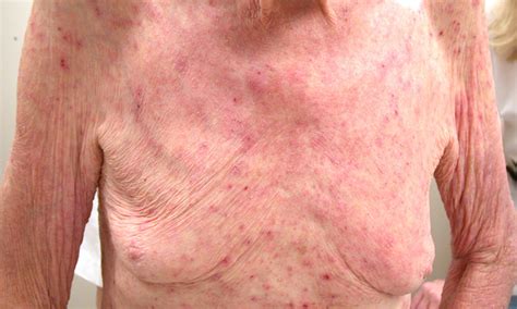Rashes That Look Like Scabies Causes Symptoms And 55 OFF
