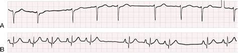 Bradyarrhythmias And Atrioventricular Block Clinical Tree