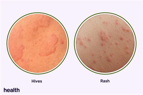 Hives Vs Rash Similarities And Differences