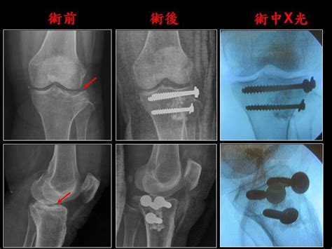 《微創手術》以關節鏡輔助治療脛骨平台骨折 骨科蔡依樽醫師