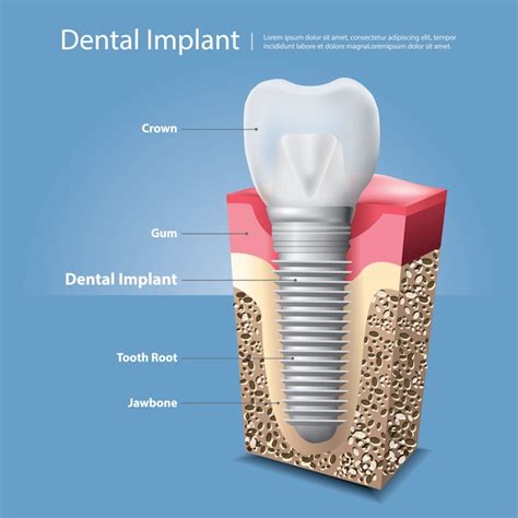 Dientes humanos e implantes dentales ilustración vectorial Vector Premium
